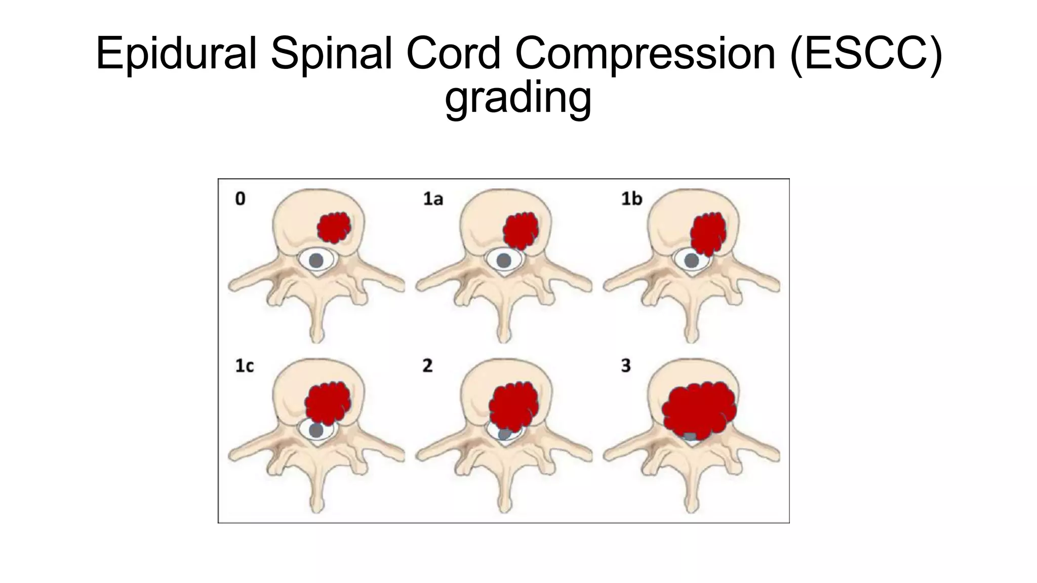spinal metastasis | PPTX