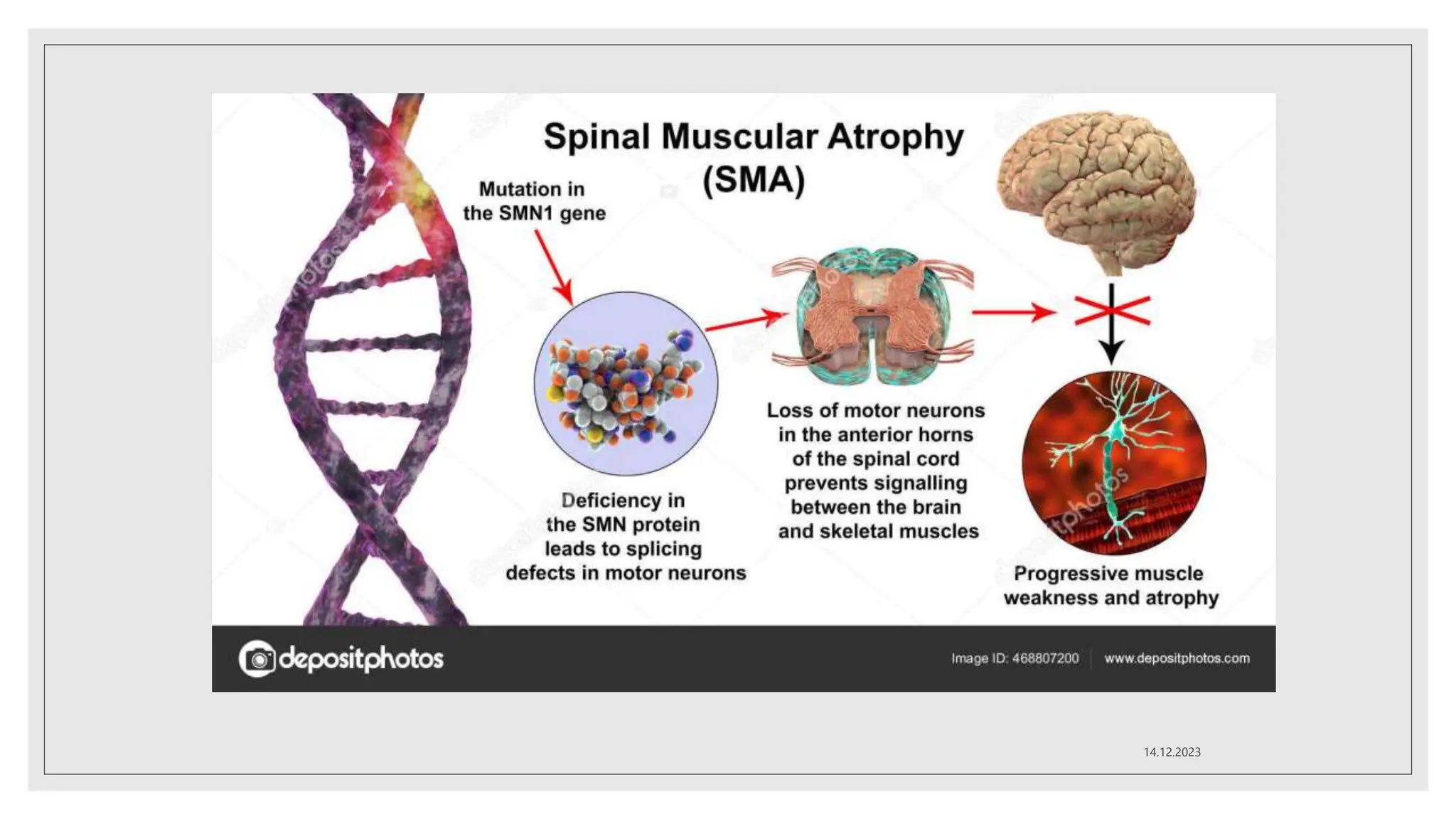 Spinal Muscular Atrophies.pptx