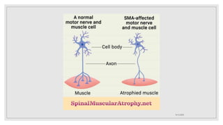 Spinal Muscular Atrophies.pptx