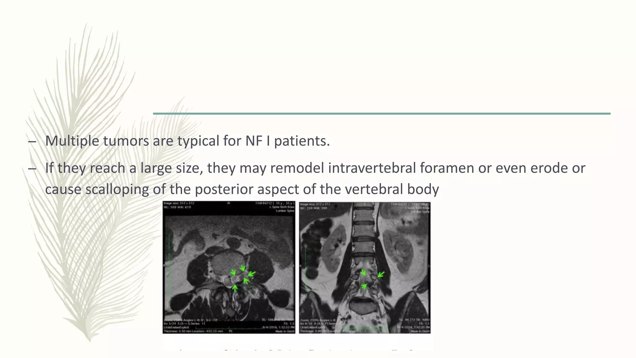 Spinal neoplasm | PPTX