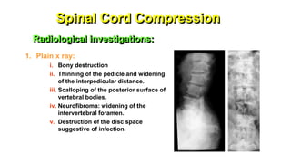 Spinal nerve root entrapment.pptx