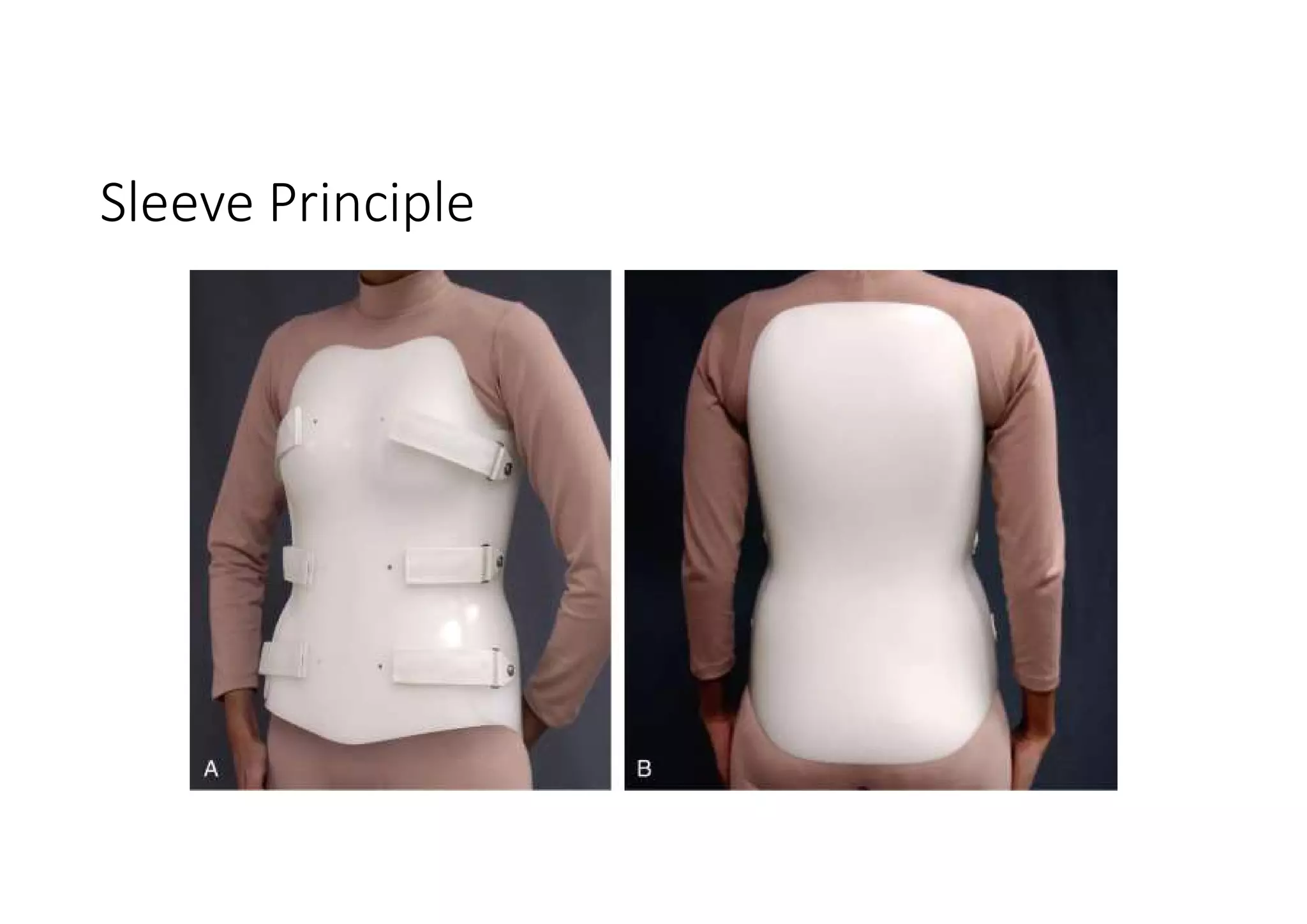 Spinal orthoses | PDF