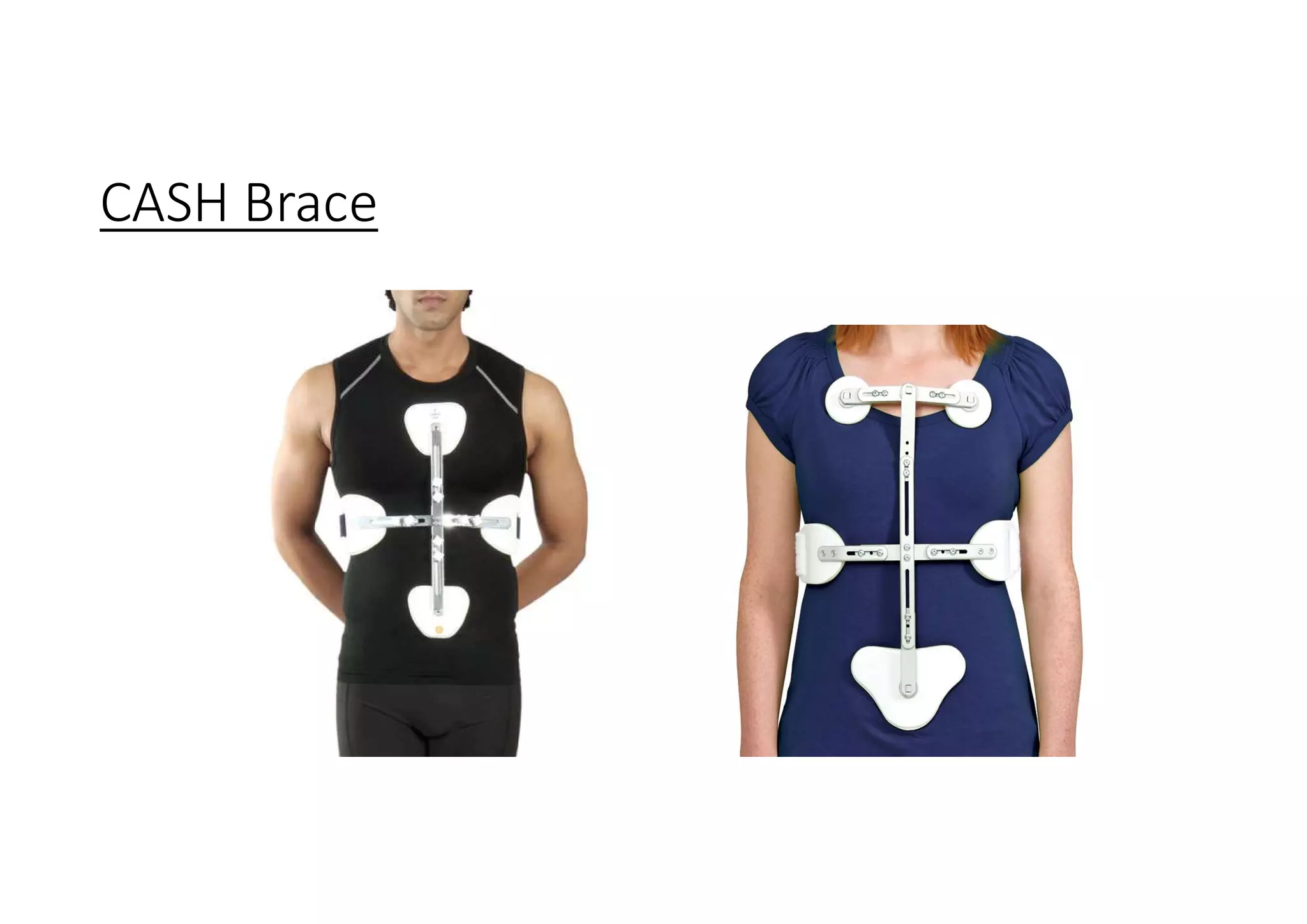 Spinal orthoses | PDF