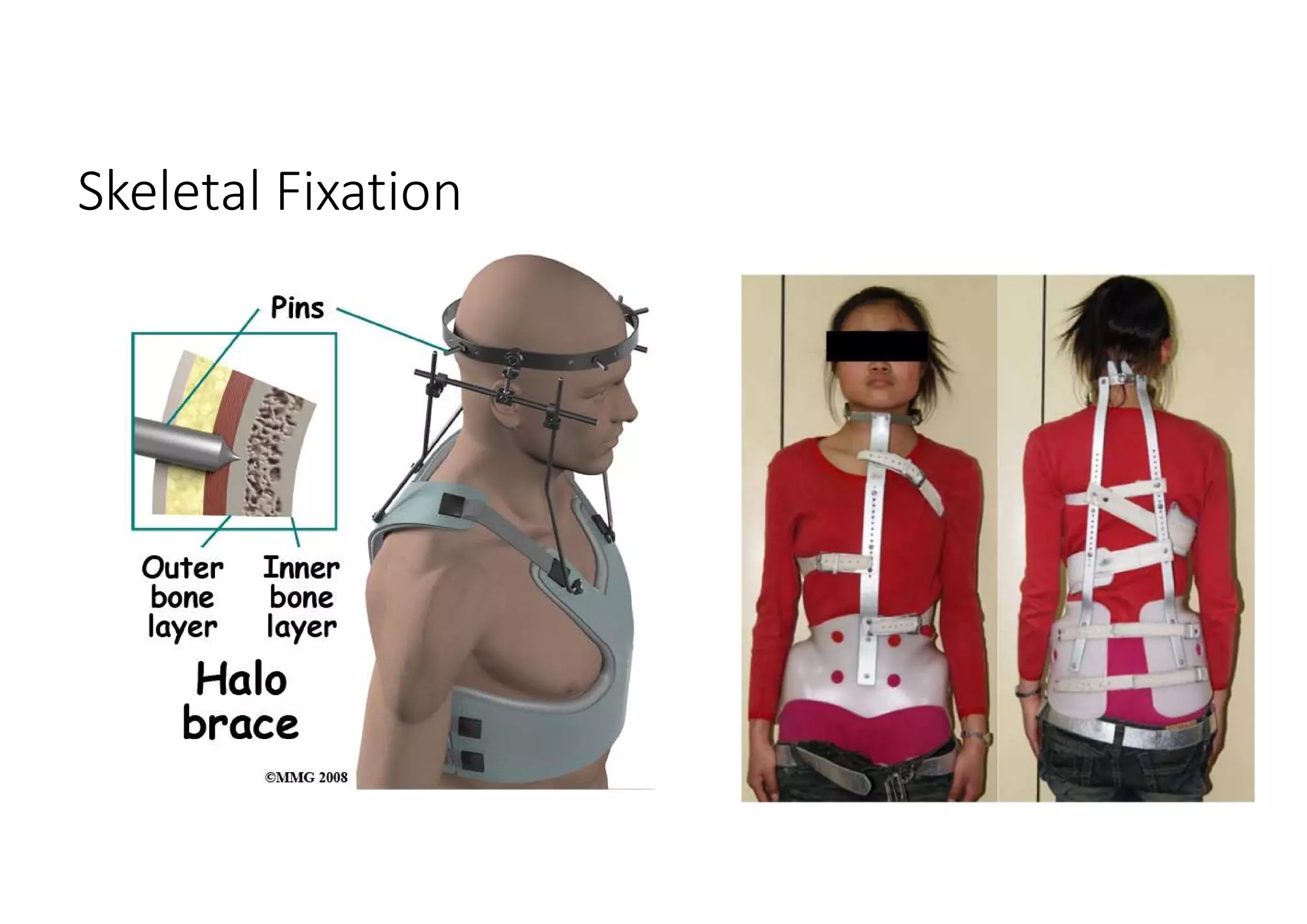 Spinal orthoses | PDF