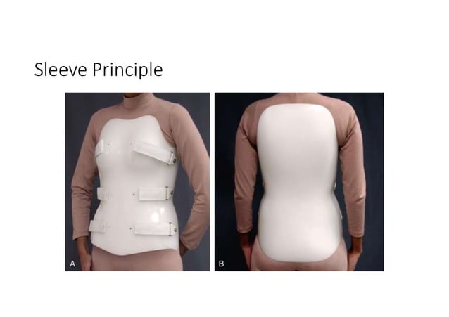 Spinal orthoses | PDF