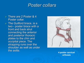 Four Poster Orthosis