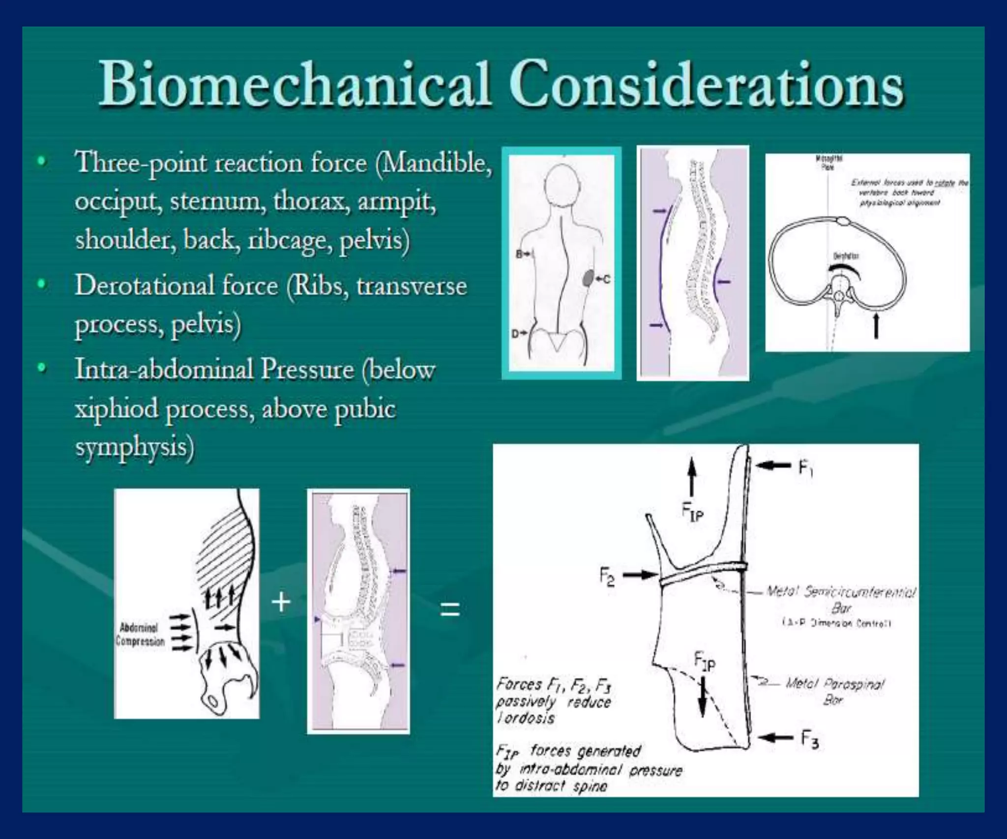 Spinal orthosis dr.aliaa | PPTX