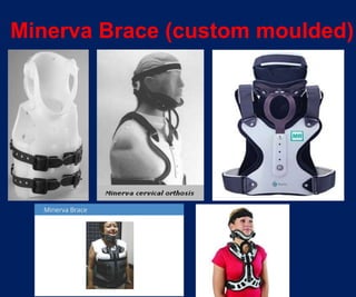 Spinal orthosis dr.aliaa | PPTX