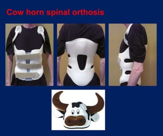 Spinal orthosis dr.aliaa | PPT