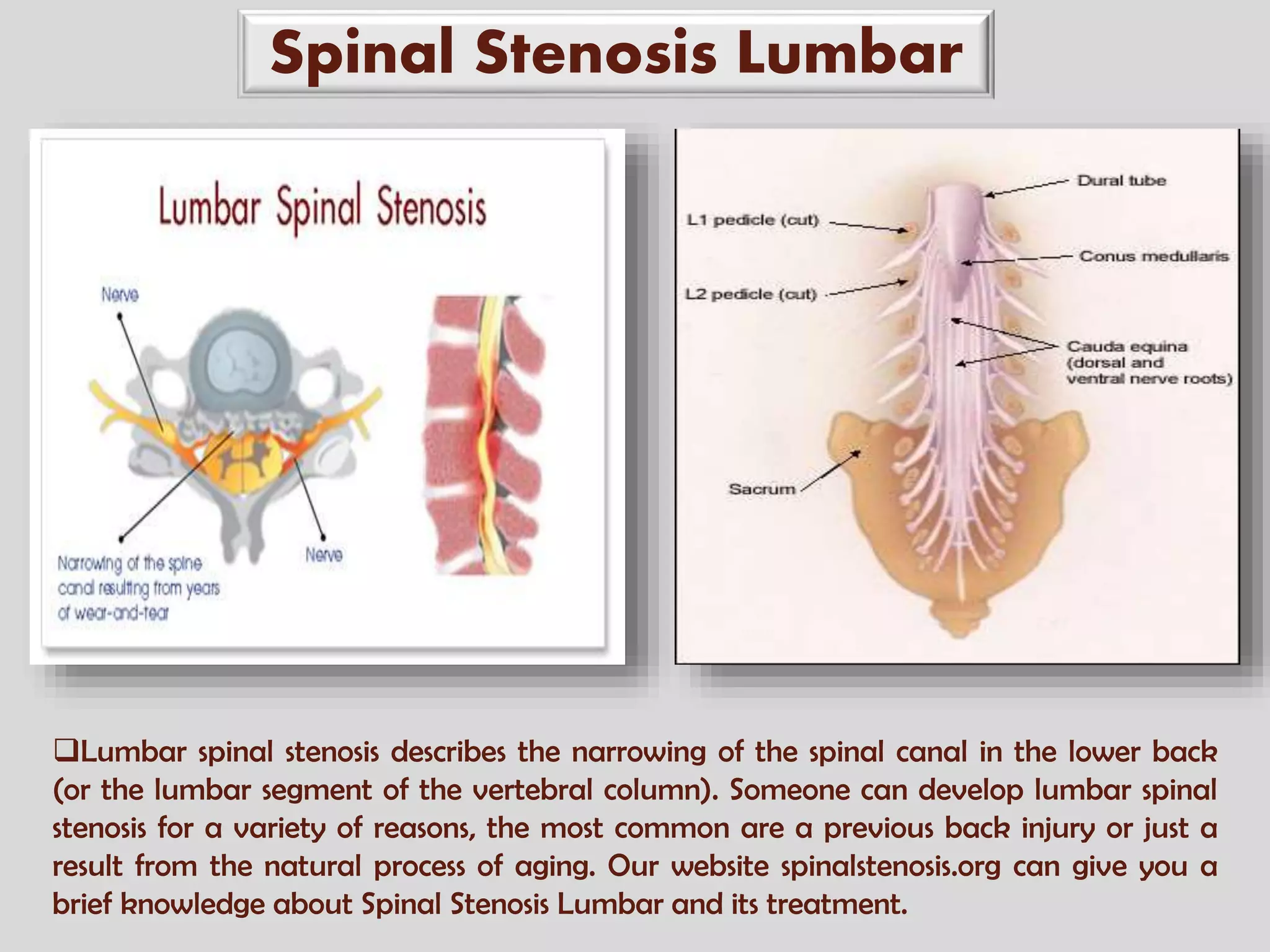 Cervical Spinal Stenosis Treatment Ppt