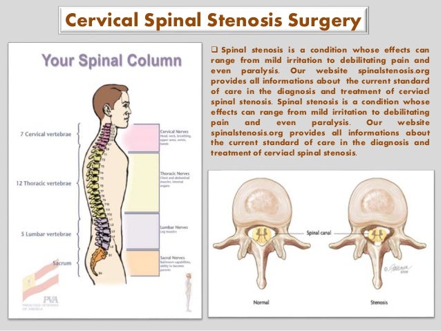 Cervical Spinal Stenosis Treatment