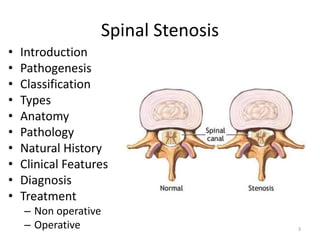 Spinal stenosis | PPTX