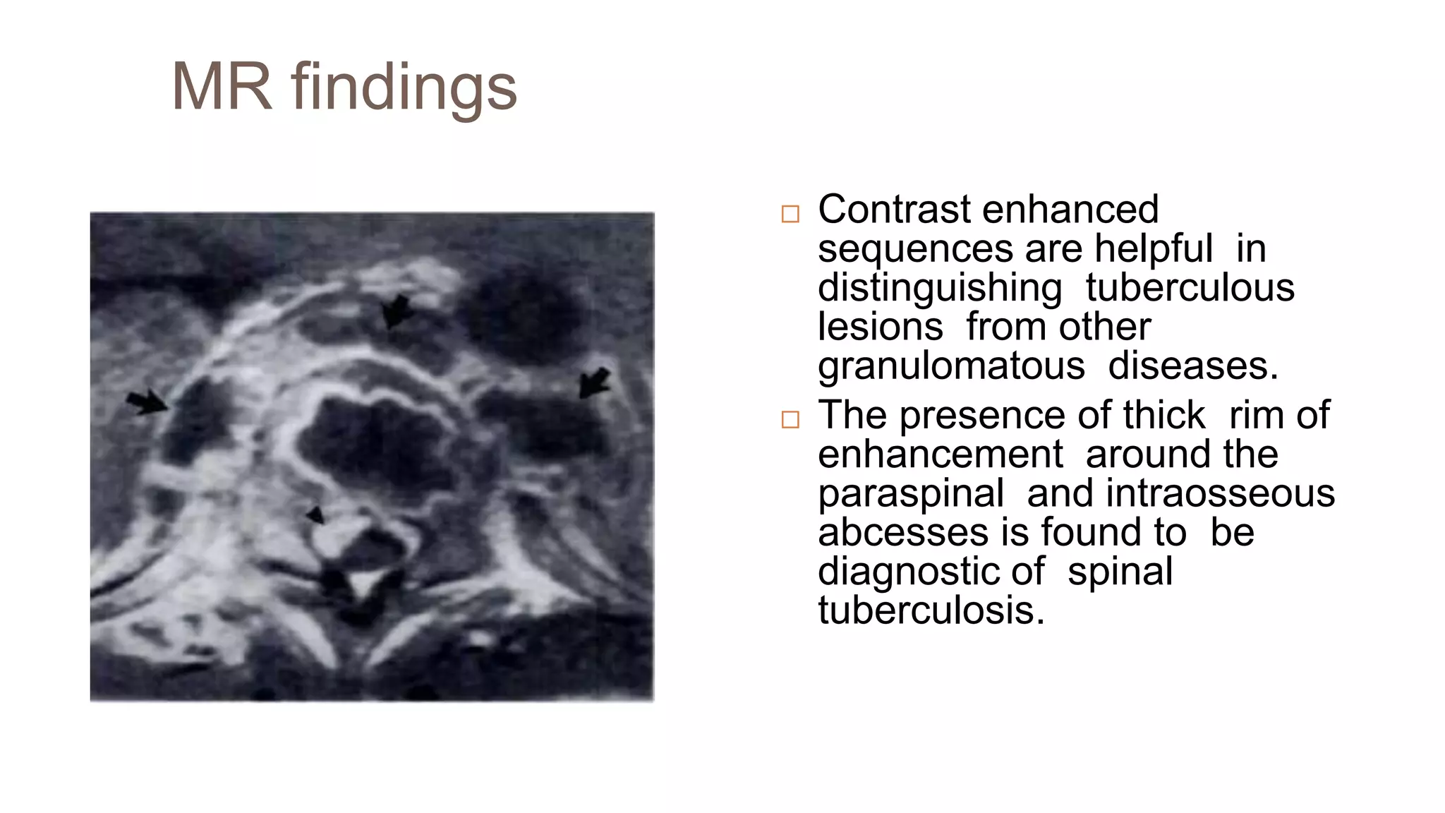 Spinal tb | PPT