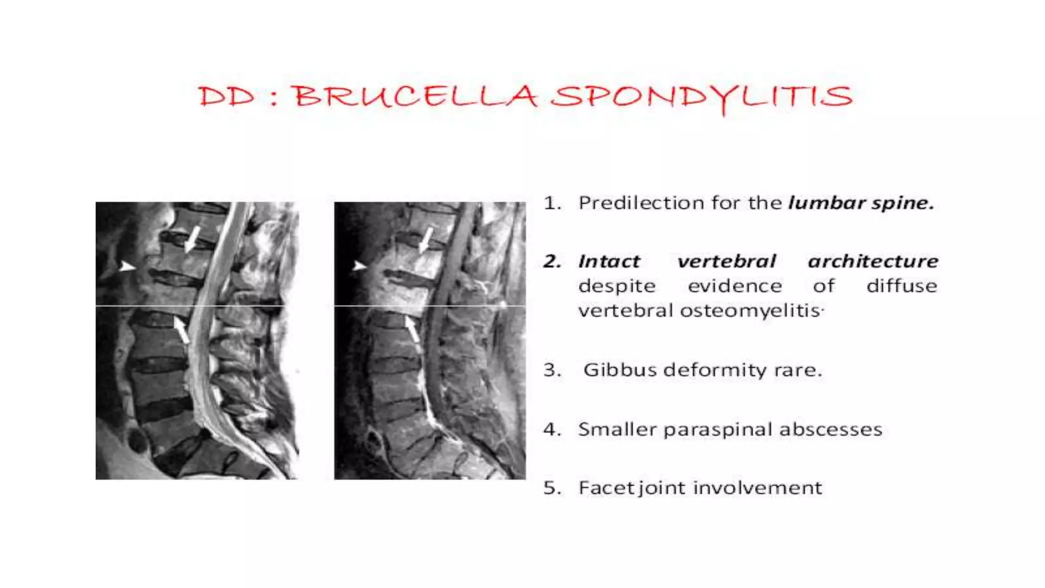 Spinal tb | PPT