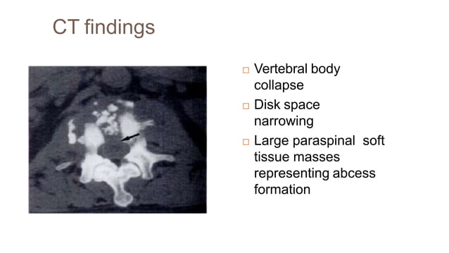Spinal tb | PPT