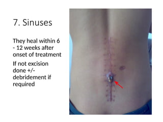 Spinal Tuberculosis features with treatment | PPT