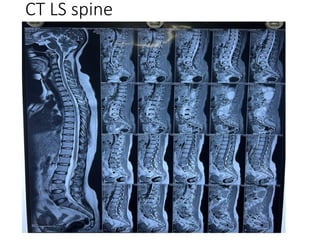 Spinal Tuberculosis features with treatment | PPT