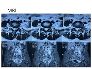 Spinal Tuberculosis features with treatment | PPT