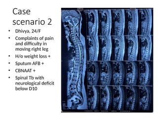 Spinal Tuberculosis features with treatment | PPT