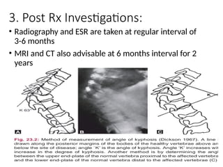 Spinal Tuberculosis features with treatment | PPT