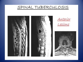 Spinal Tuberculosis by Dr. Monsif Iqbal | PPTX