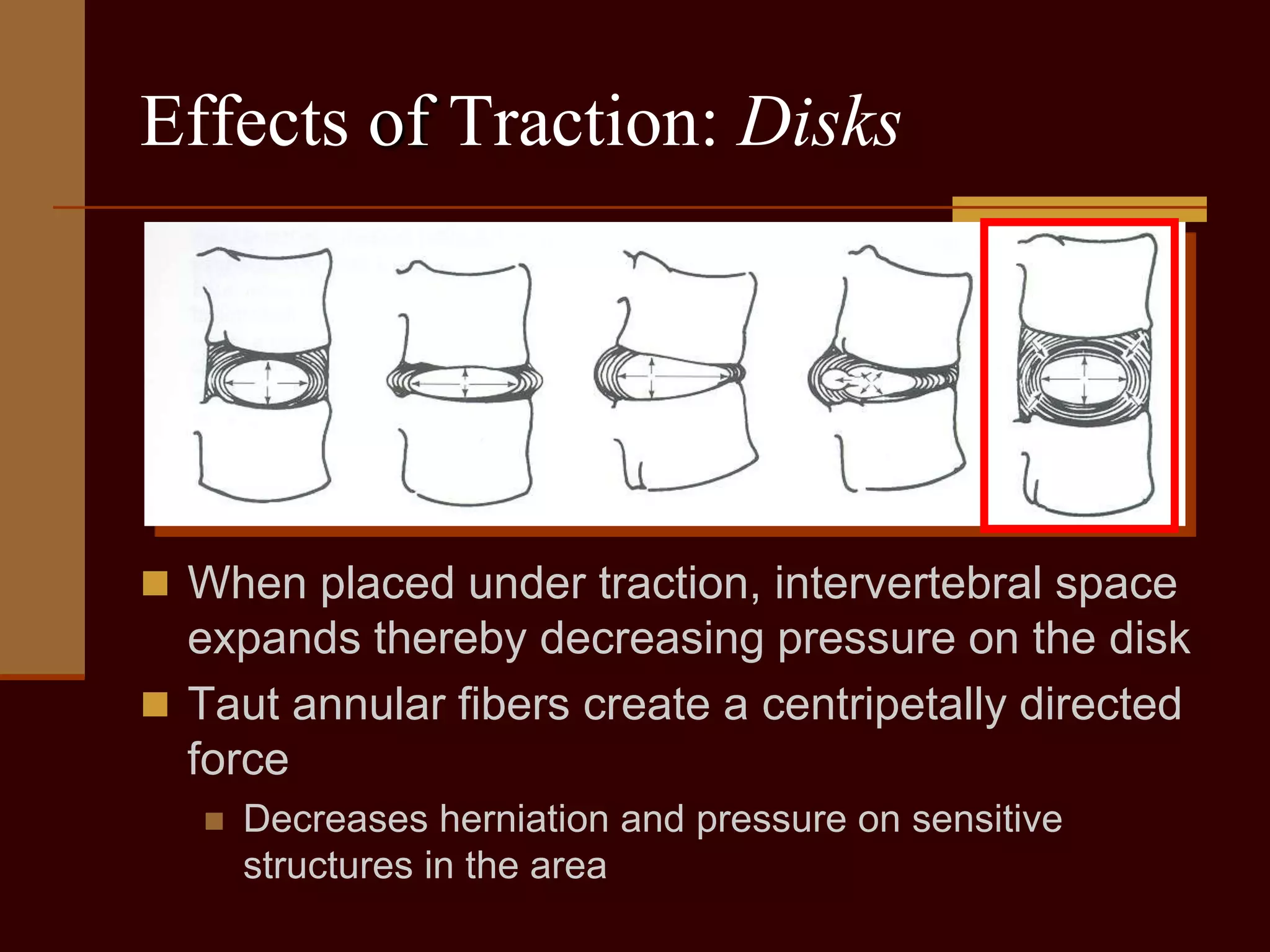 Spinal traction 1 | PPT