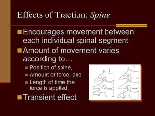 Spinal traction 1 | PPT