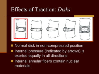 Spinal traction 1 | PPT