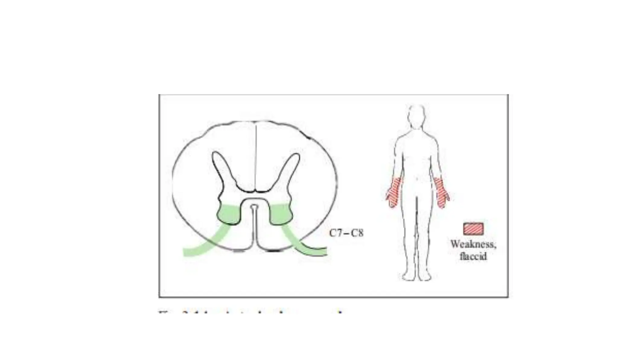 Spinal transection.pptx