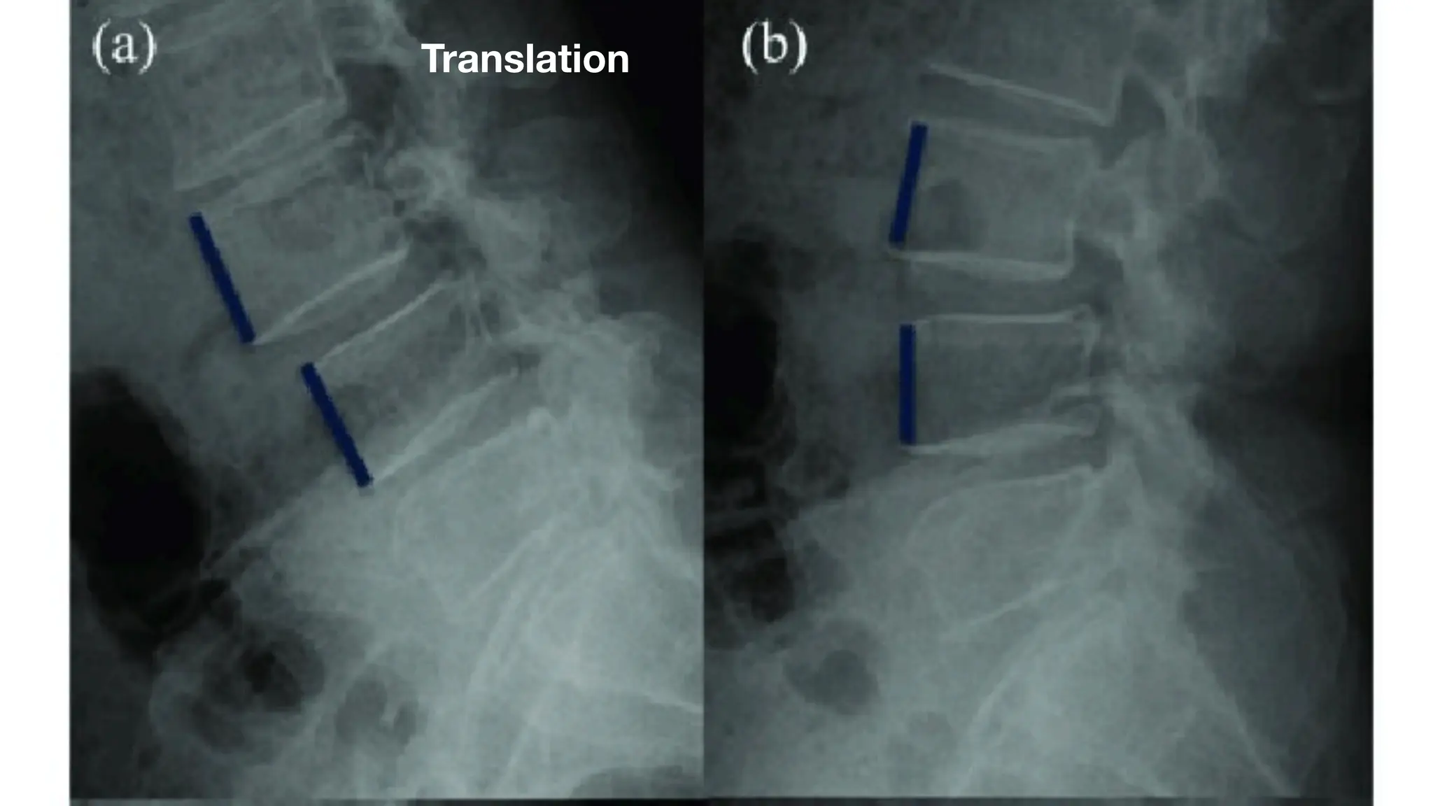 Spinal Trauma (a guide to diagnosis & Treatment) | PDF
