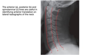 Spinal Trauma (a guide to diagnosis & Treatment) | PDF