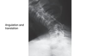 Spinal Trauma (a guide to diagnosis & Treatment) | PDF