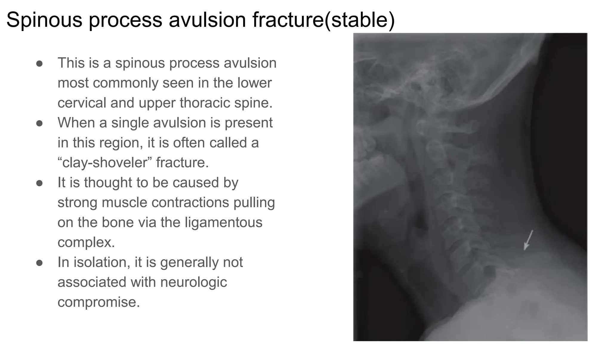 SPINAL TRAUMA ITS ANATOMY AND EMERGENCY MANAGEMENT OF | PPTX