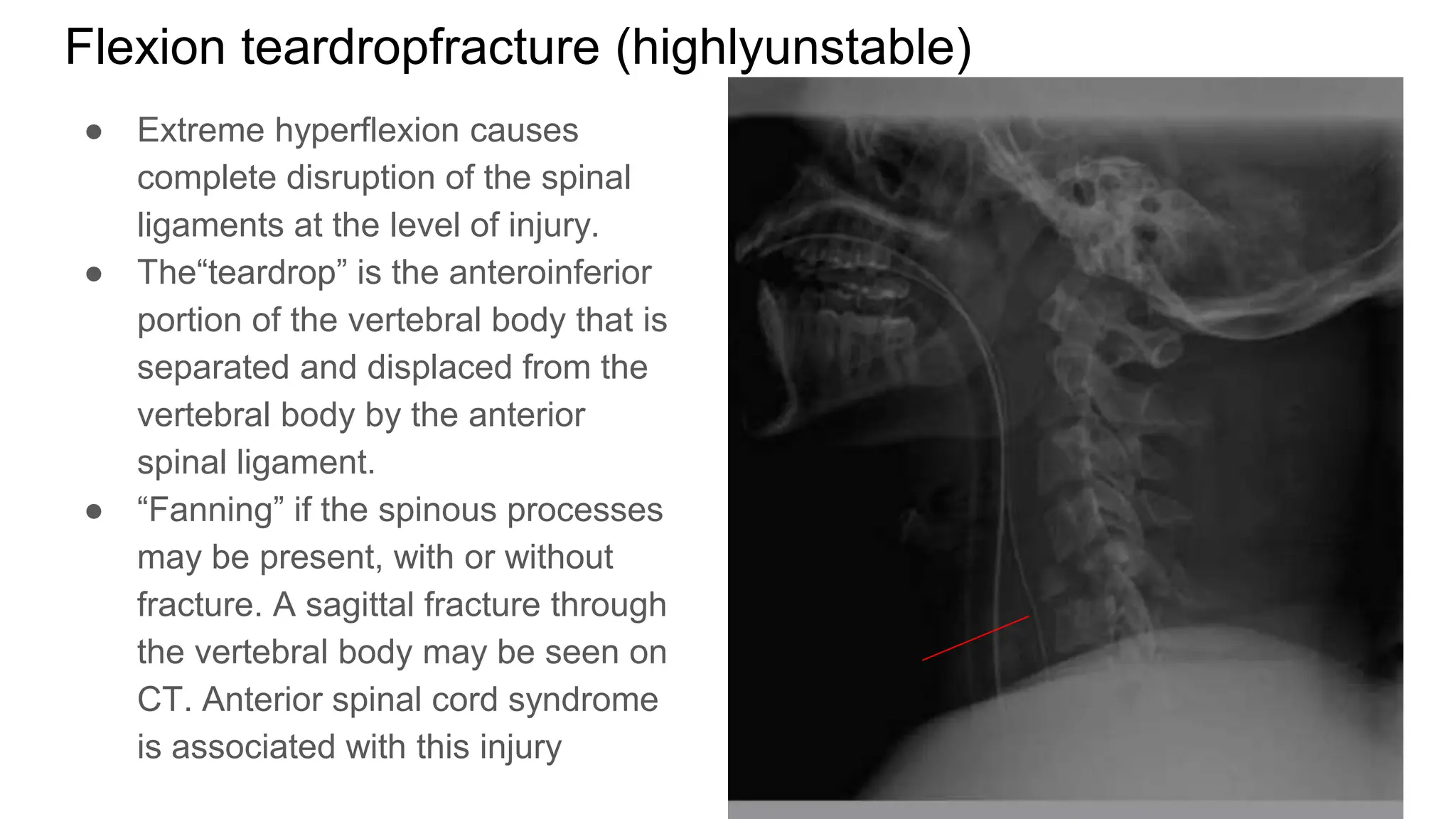 SPINAL TRAUMA ITS ANATOMY AND EMERGENCY MANAGEMENT OF | PPTX