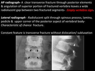 A Split In Spinous Process