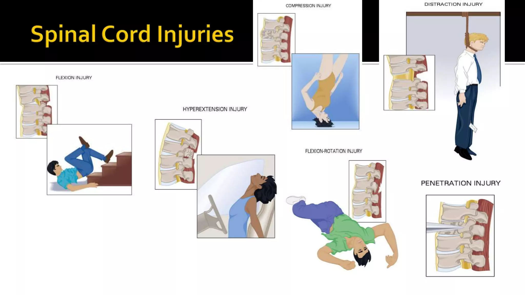 Spinal trauma wo anatomy | PPTX