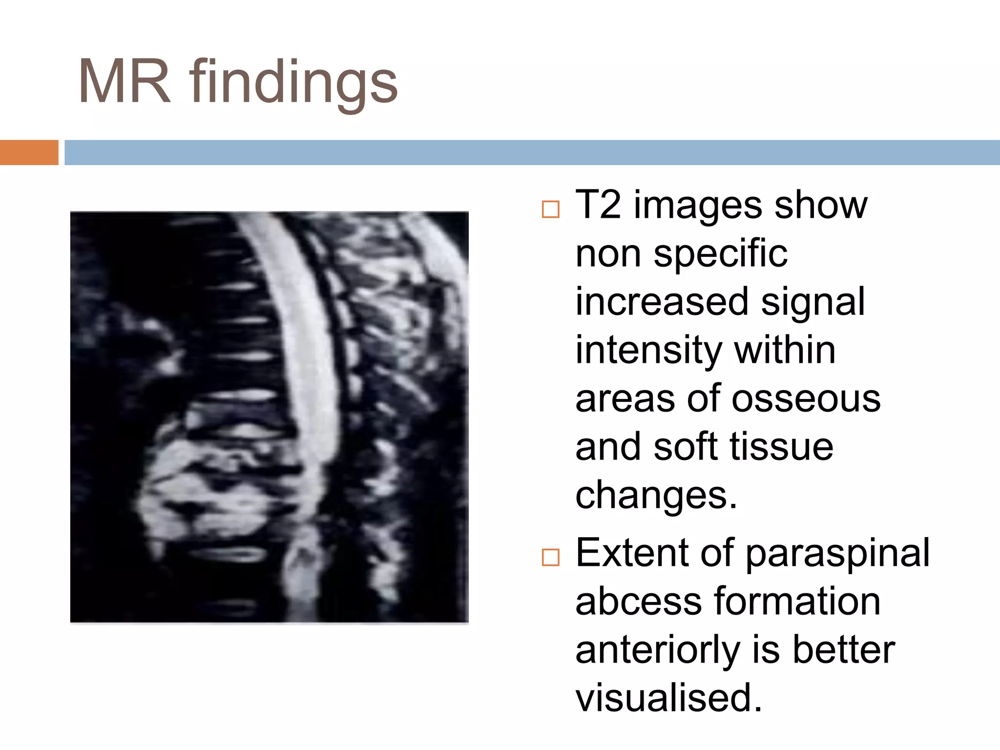 Spinal tuberculosis | PPTX