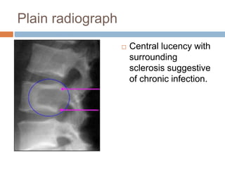 Spinal tuberculosis | PPTX