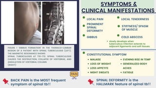 Spinal tuberculosis (simplified) | PPT