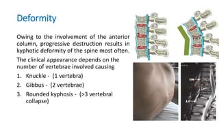 Spinal Tuberculosis: Current Concepts Dr. rajasekaran | PPTX