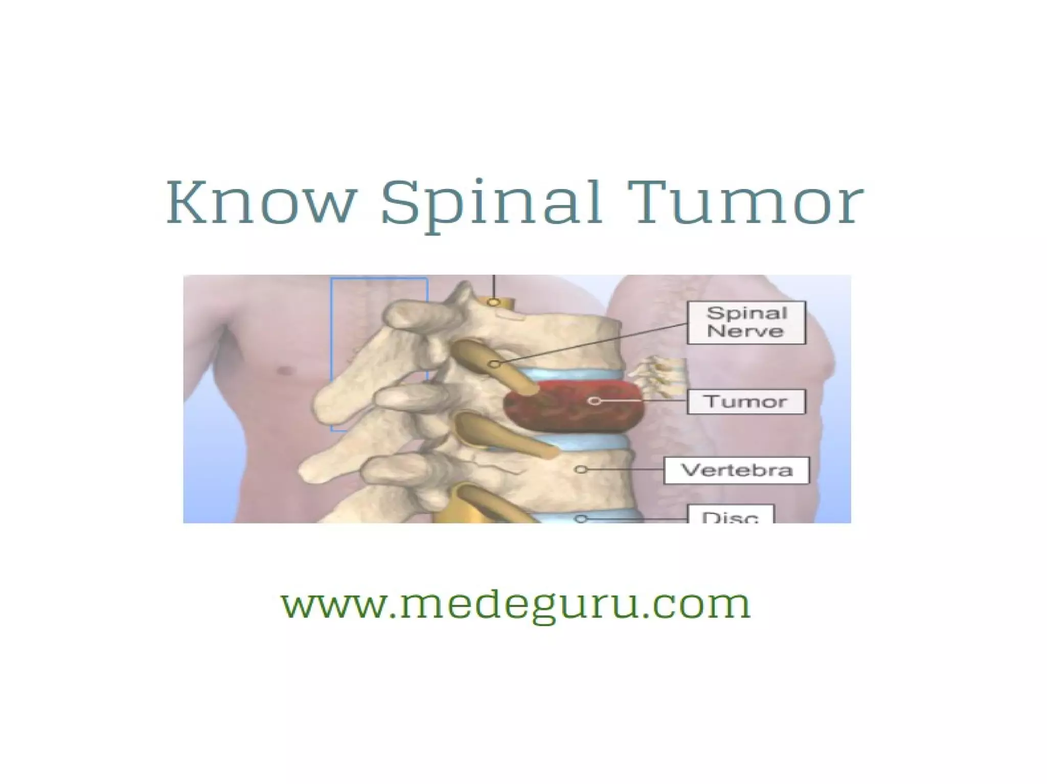 Spinal tumor | ODP