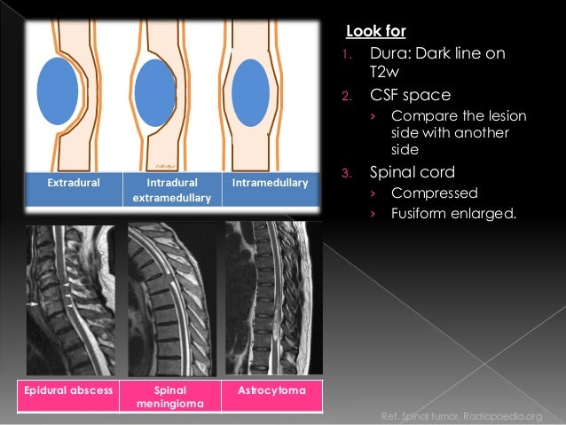 Spinal tumor