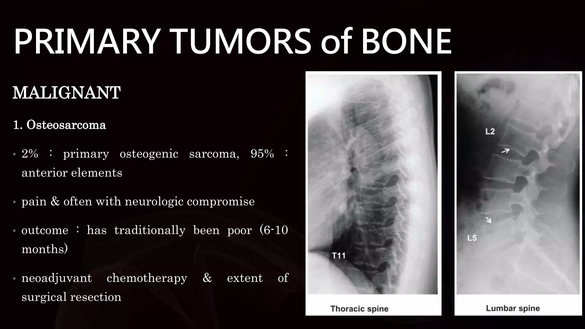 Spinal Tumor.pptx