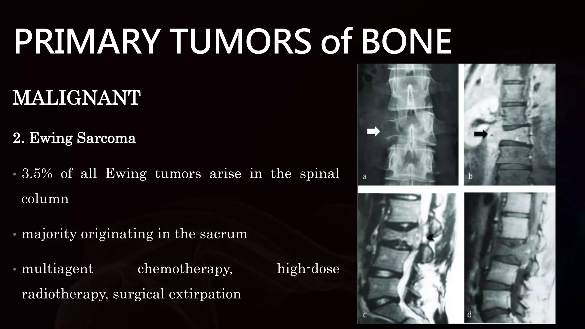 Spinal Tumor.pptx