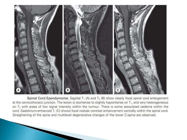 SPINAL TUMOR.pptx