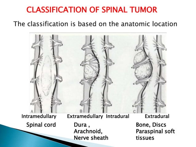 SPINAL TUMOR.pptx
