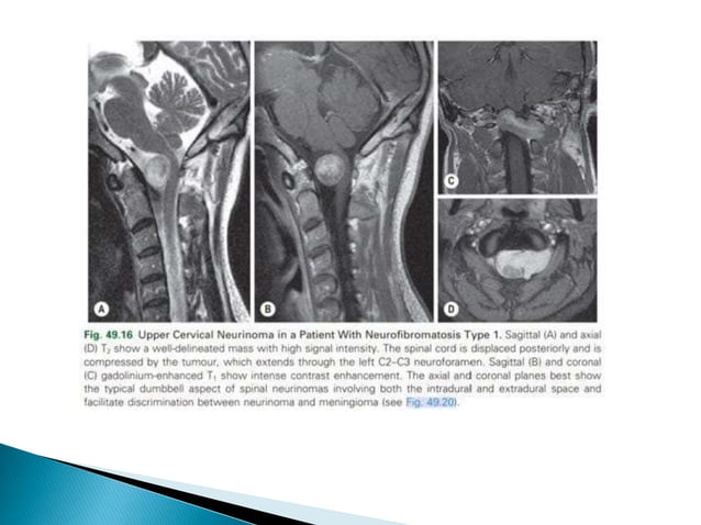 SPINAL TUMOR.pptx