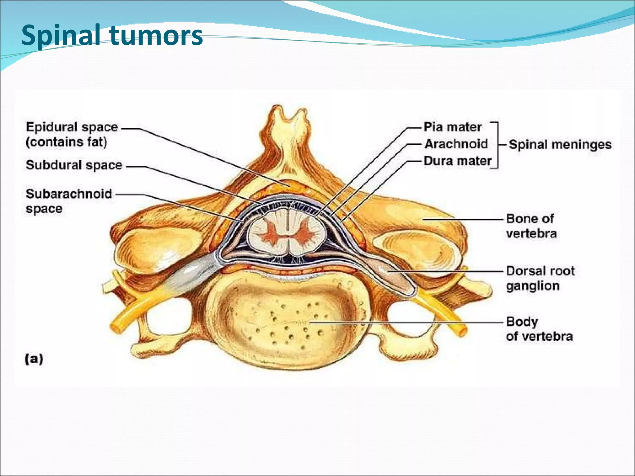 Spinal tumors lecture | PPT