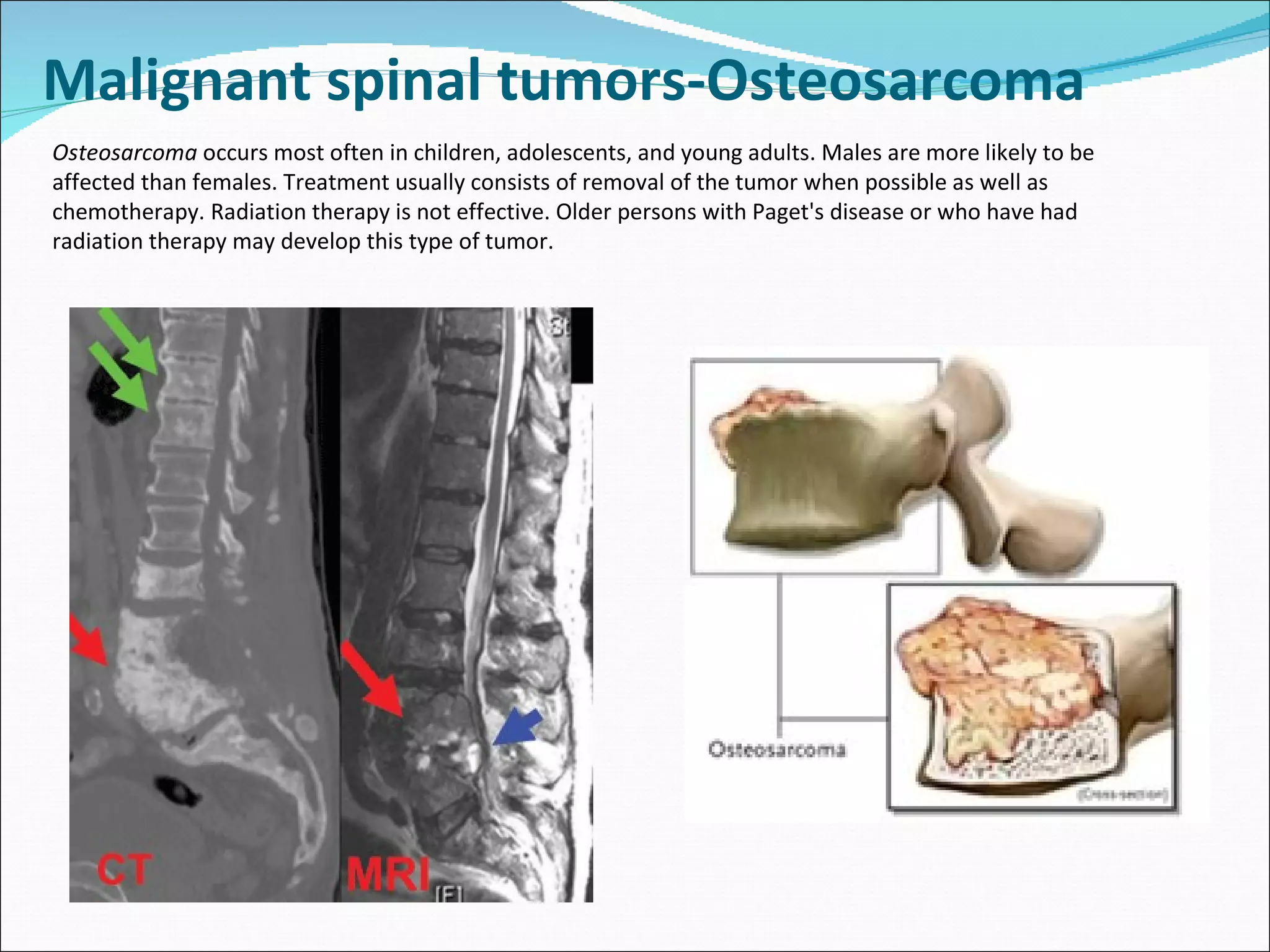 Spinal tumors lecture | PPT