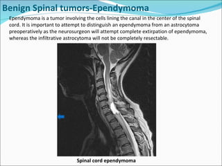 Spinal tumors lecture | PPT
